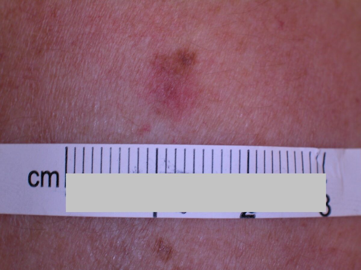 Melanoma - Skin Cancer Removal and Treatment | Brisbane