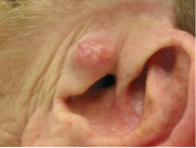 BCC Cancer - Skin Cancer Removal and Treatment | Brisbane
