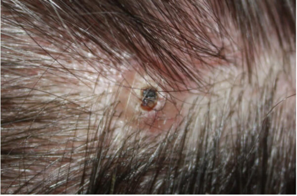 BCC Cancer - Skin Cancer Removal and Treatment | Brisbane